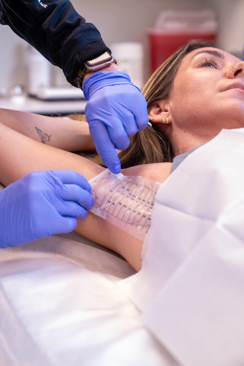 miraDry San Jose, CA | miraDry Palo Alto | Illuminate Plastic Surgery